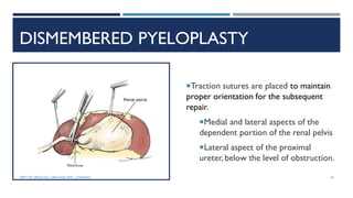 Pediatric urology pujo- pyeloplasty | PDF