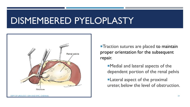 Pediatric urology pujo- pyeloplasty | PDF | Surgery | Medical Health
