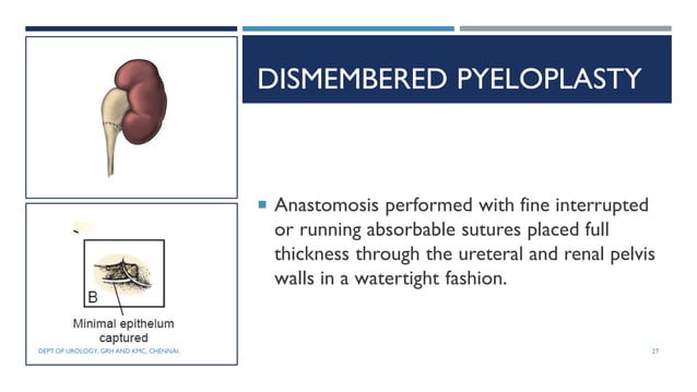 Pediatric urology pujo- pyeloplasty | PDF | Surgery | Medical Health