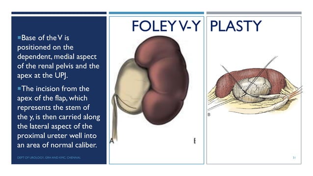 Pediatric urology pujo- pyeloplasty | PDF | Surgery | Medical Health