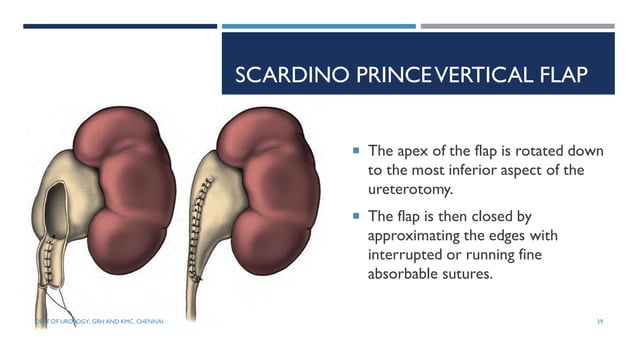 Pediatric urology pujo- pyeloplasty | PDF | Surgery | Medical Health