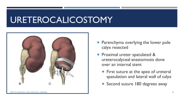 Pediatric urology pujo- pyeloplasty | PDF | Surgery | Medical Health