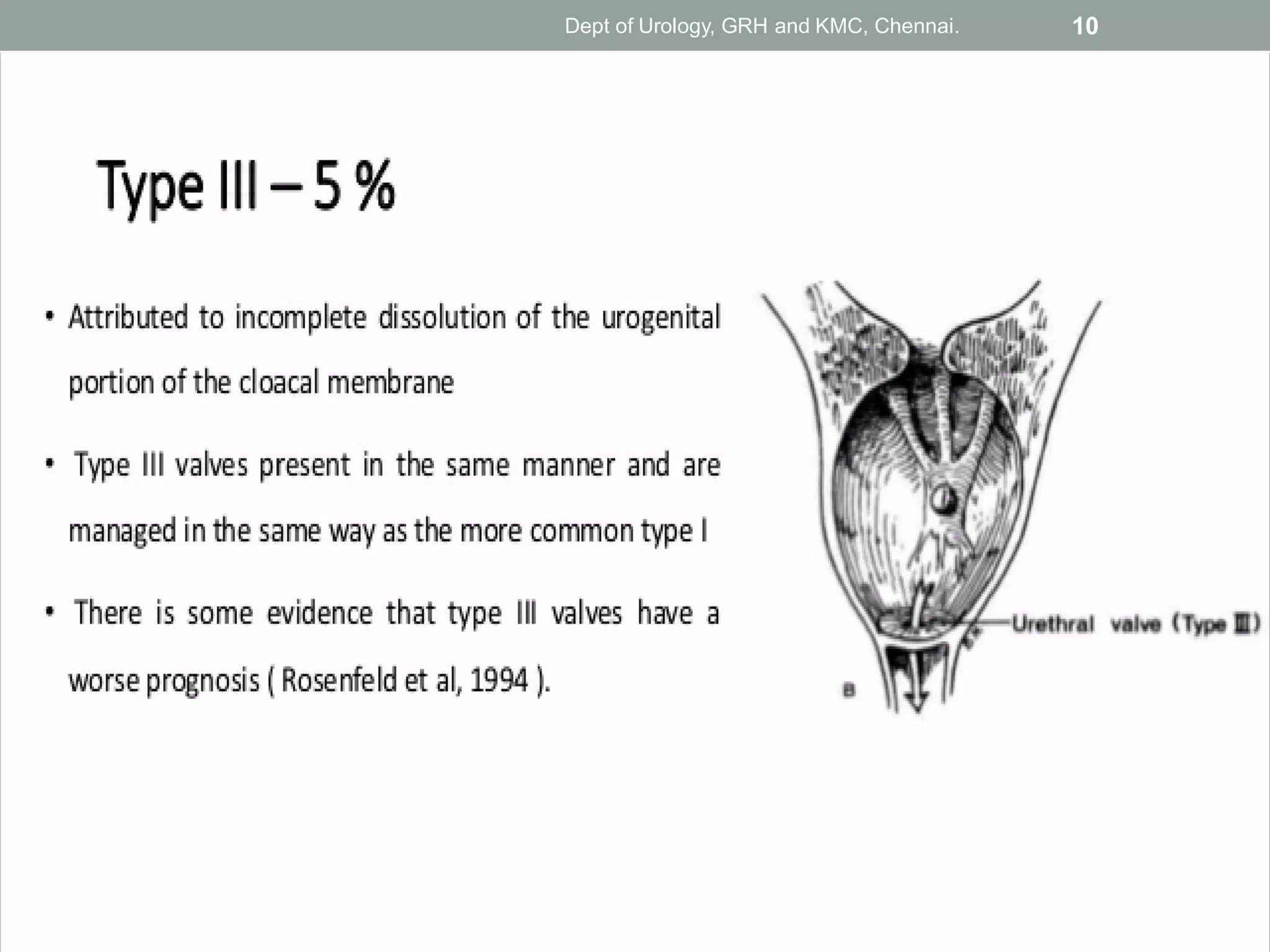 Pediatric urology :Posterior Urethral Valve (PUV)- diagnosis ...