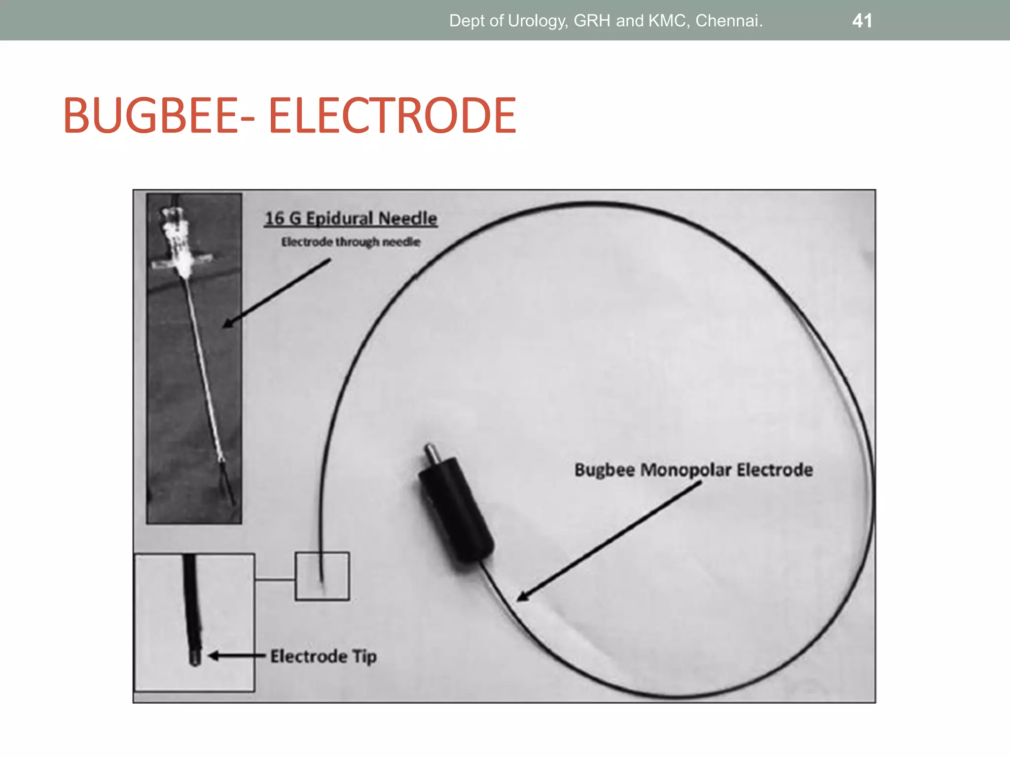 Pediatric urology :Posterior Urethral Valve (PUV)- diagnosis ...
