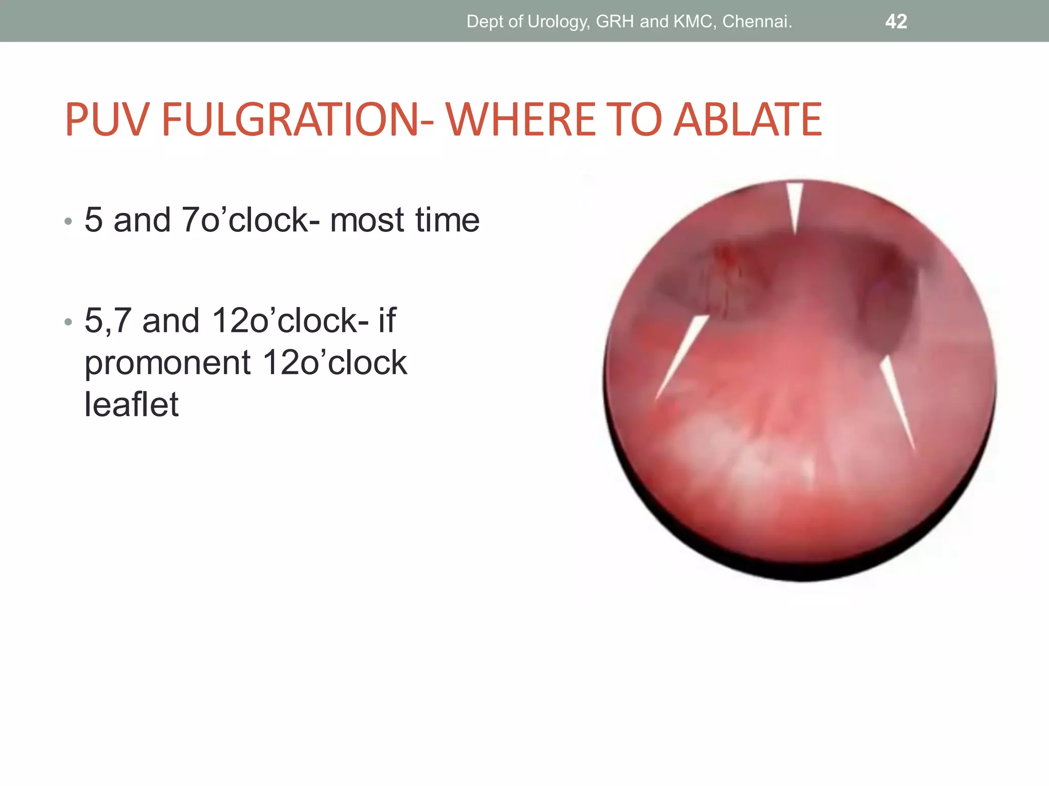 Pediatric urology :Posterior Urethral Valve (PUV)- diagnosis ...