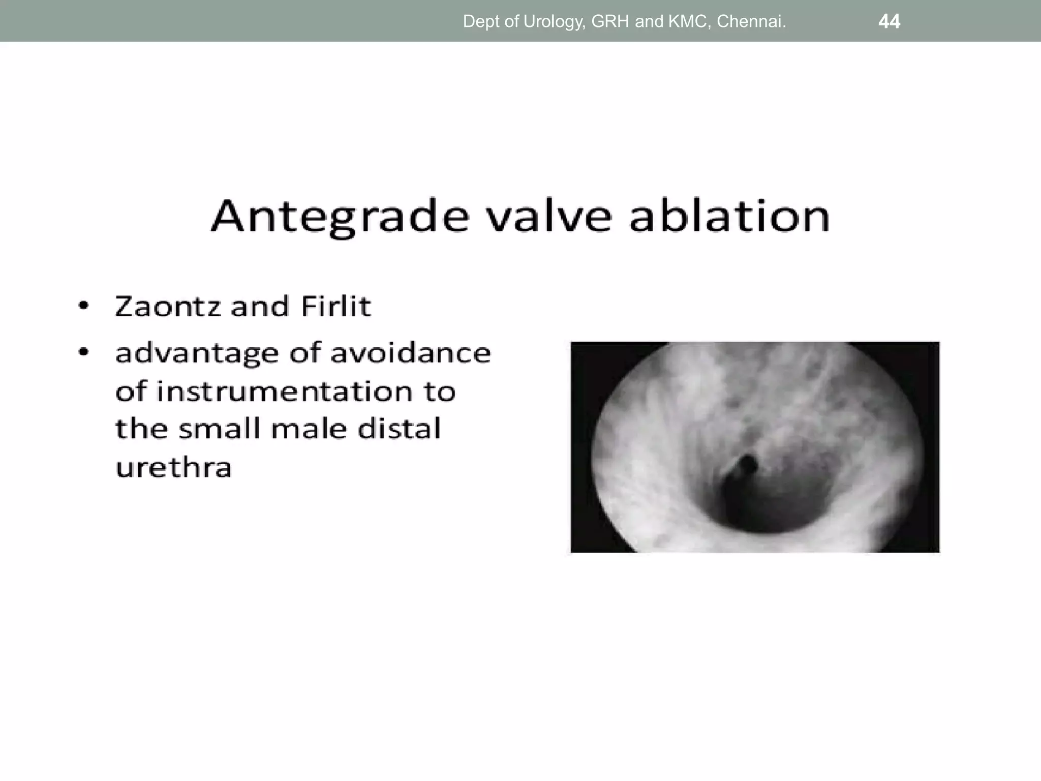 Pediatric urology :Posterior Urethral Valve (PUV)- diagnosis ...