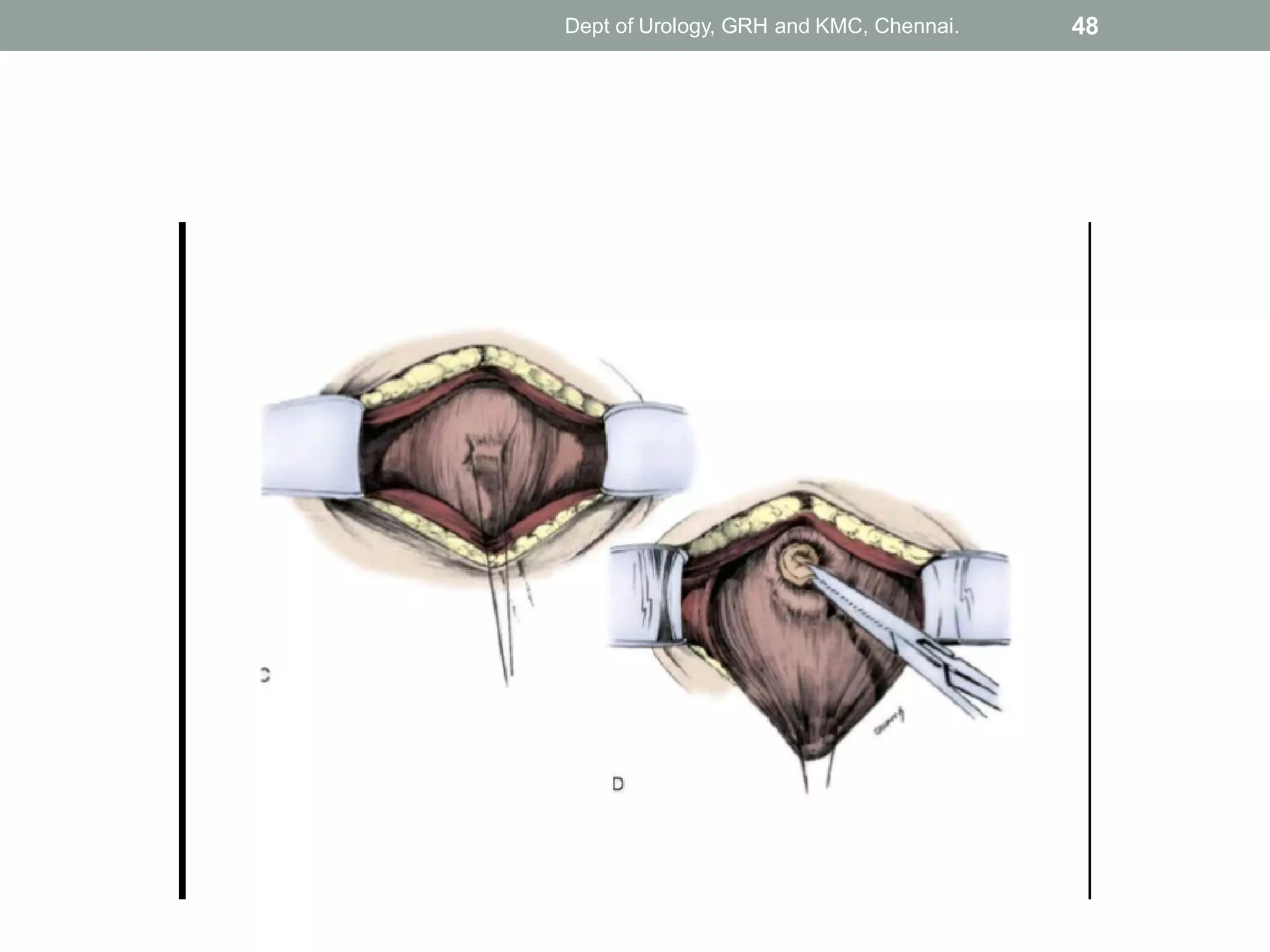 Pediatric urology :Posterior Urethral Valve (PUV)- diagnosis ...