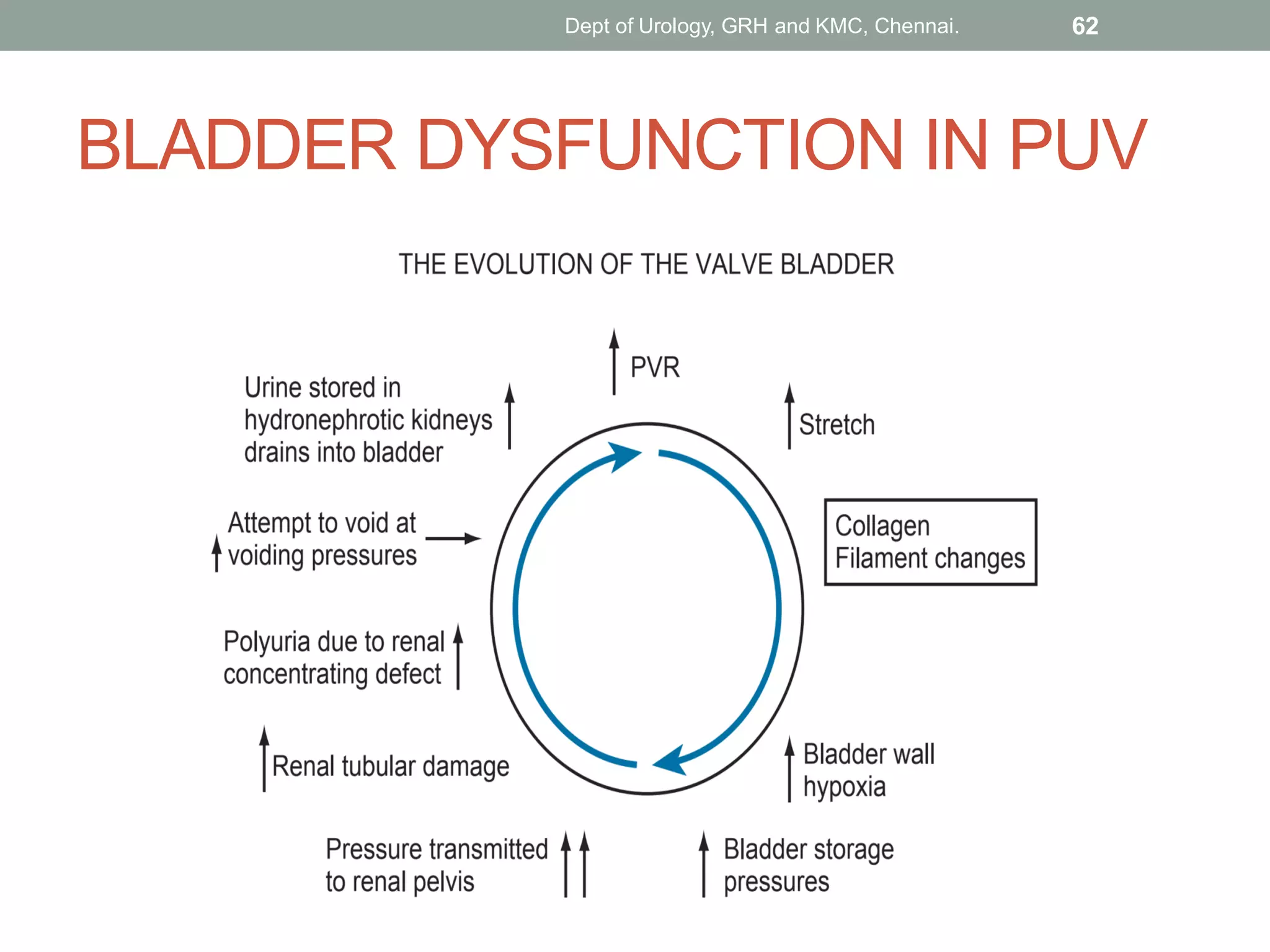 Pediatric urology :Posterior Urethral Valve (PUV)- diagnosis ...