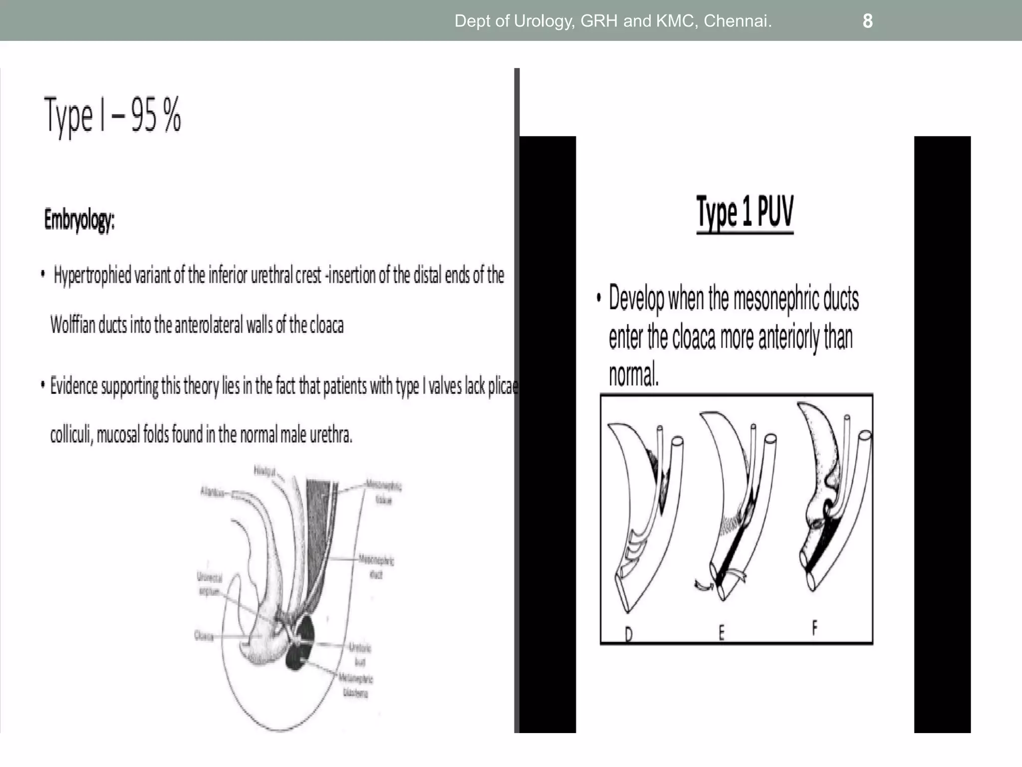 Pediatric urology :Posterior Urethral Valve (PUV)- diagnosis ...