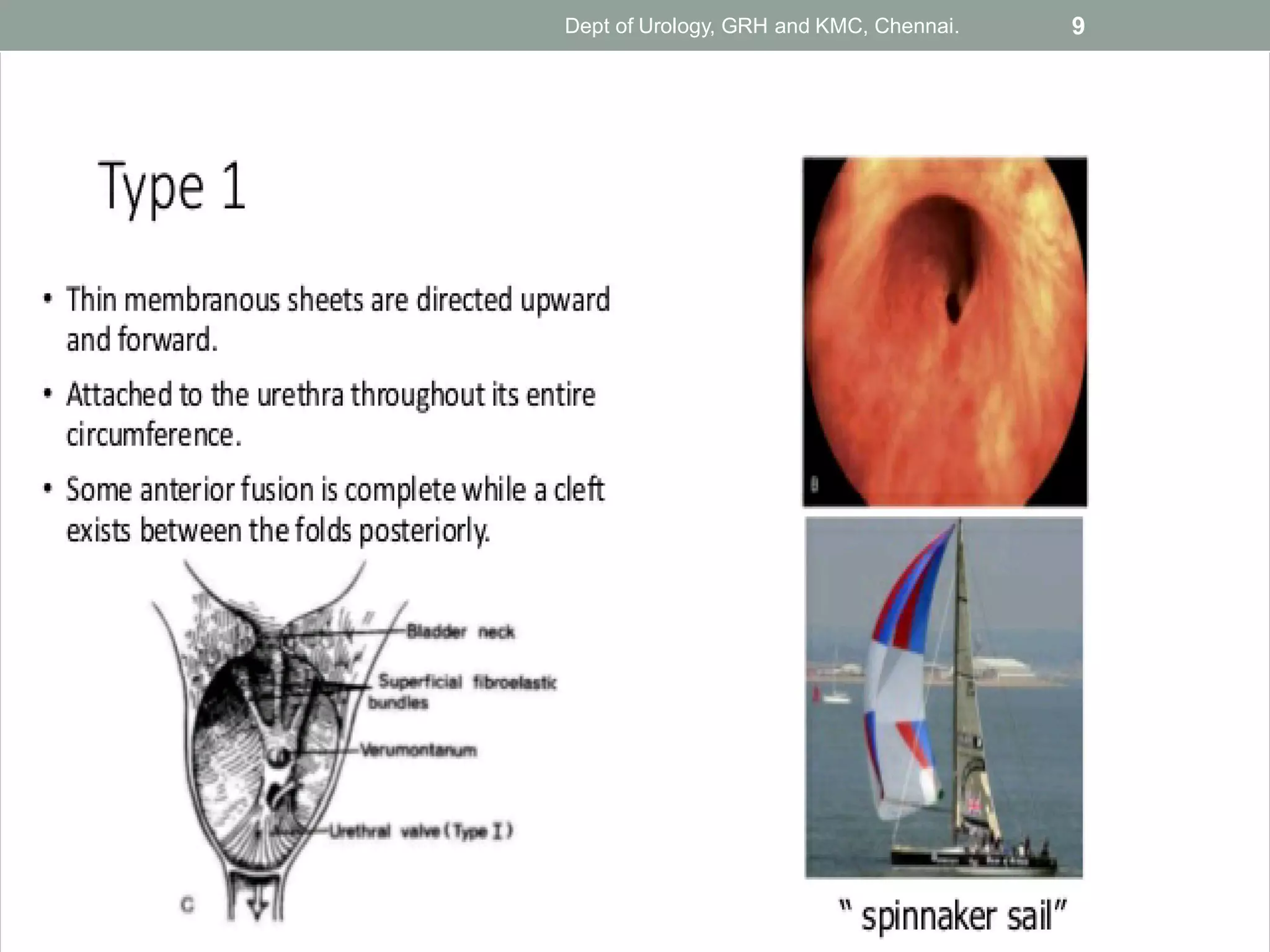 Pediatric urology :Posterior Urethral Valve (PUV)- diagnosis ...