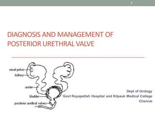 Pediatric urology :Posterior Urethral Valve (PUV)- diagnosis ...