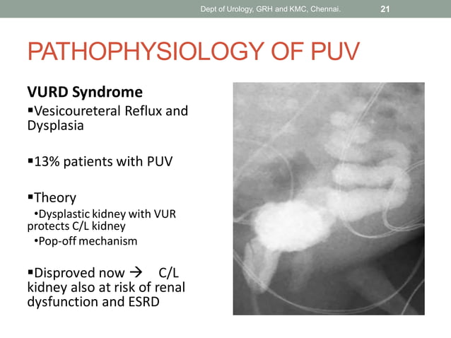 Pediatric urology :Posterior Urethral Valve (PUV)- diagnosis ...