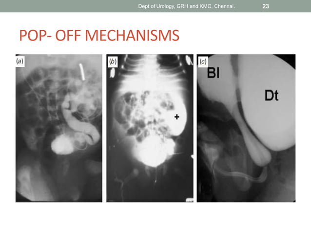 Pediatric urology :Posterior Urethral Valve (PUV)- diagnosis ...