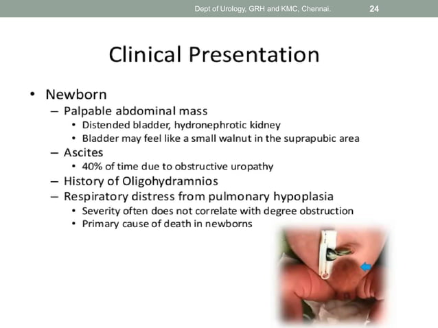 Pediatric urology :Posterior Urethral Valve (PUV)- diagnosis ...