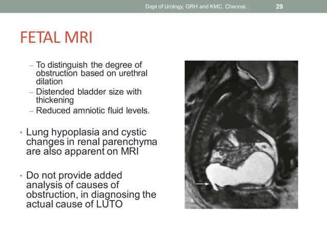 Pediatric urology :Posterior Urethral Valve (PUV)- diagnosis ...