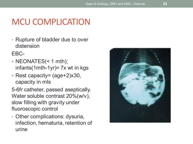 Pediatric urology :Posterior Urethral Valve (PUV)- diagnosis ...