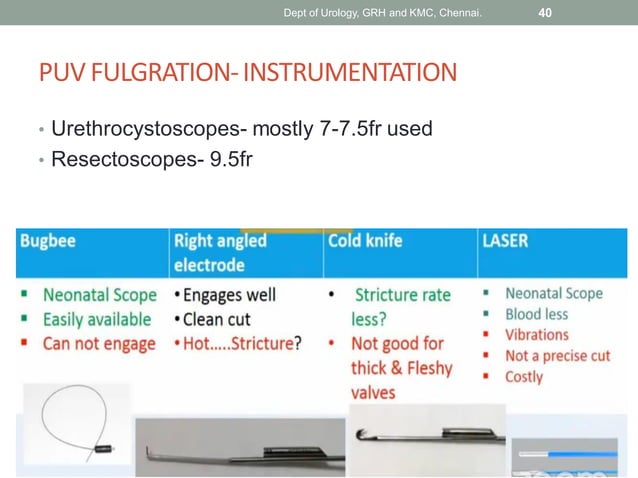 Pediatric urology :Posterior Urethral Valve (PUV)- diagnosis ...