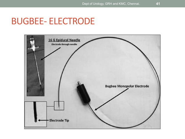 Pediatric urology :Posterior Urethral Valve (PUV)- diagnosis ...