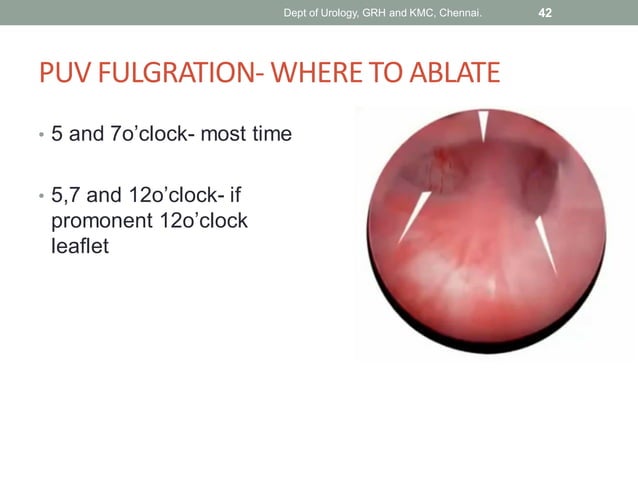 Pediatric urology :Posterior Urethral Valve (PUV)- diagnosis ...