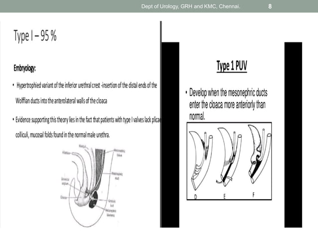 Pediatric urology :Posterior Urethral Valve (PUV)- diagnosis ...