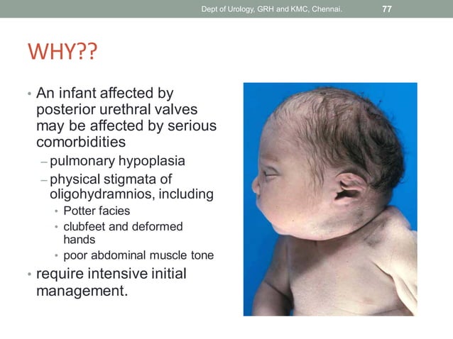 Pediatric urology :Posterior Urethral Valve (PUV)- diagnosis ...