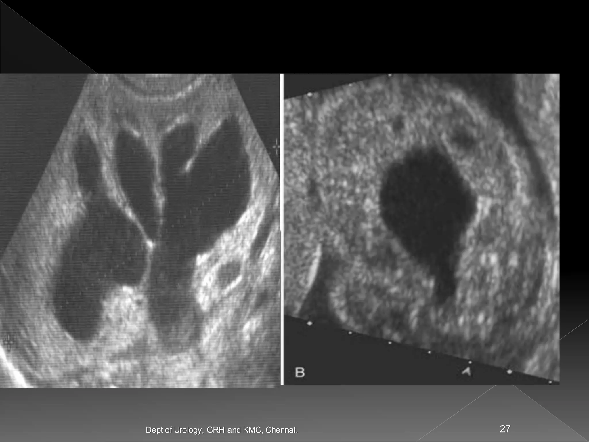 Pediatric urology : PUV- overview | PDF