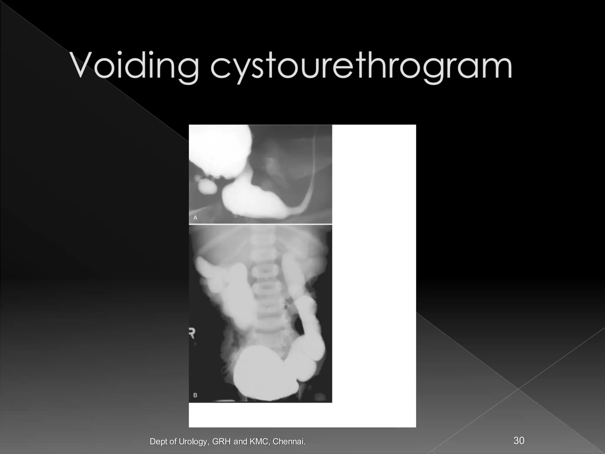 Pediatric urology : PUV- overview | PDF