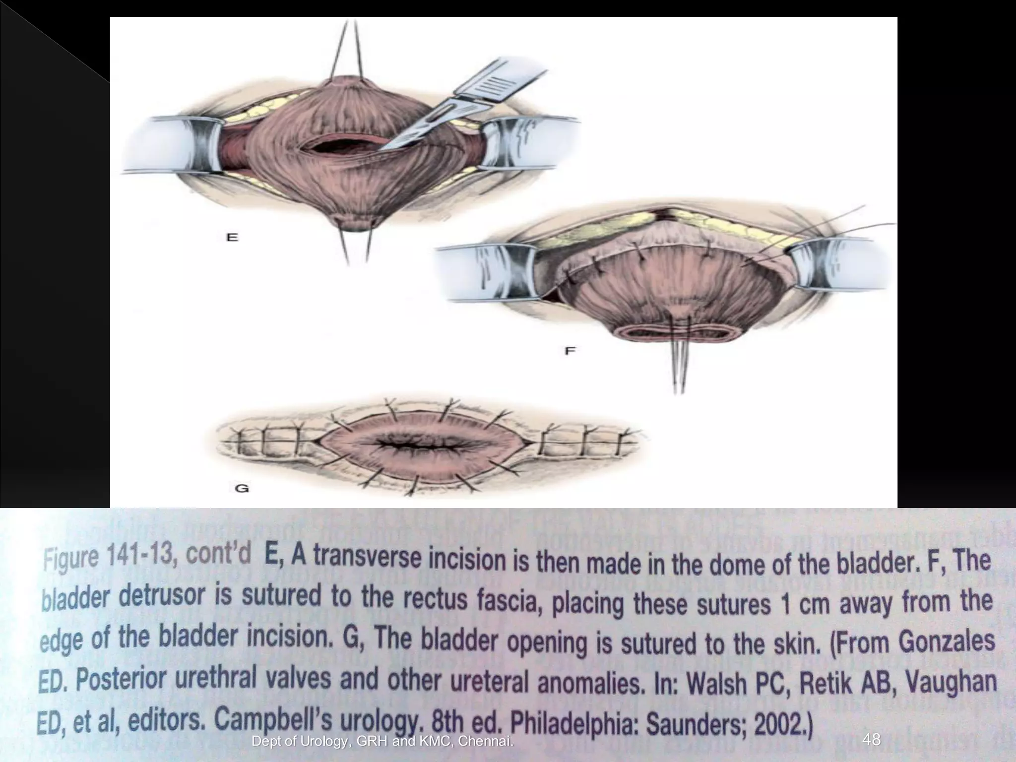 Pediatric urology : PUV- overview | PDF