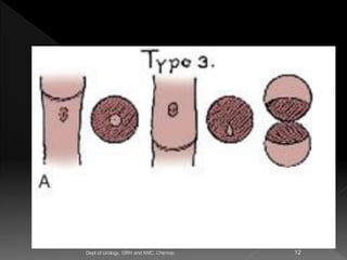 Pediatric urology : PUV- overview | PPT