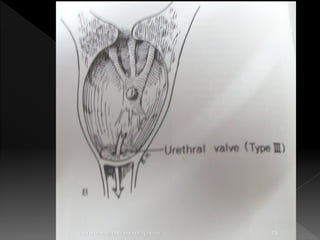 Pediatric urology : PUV- overview | PPT