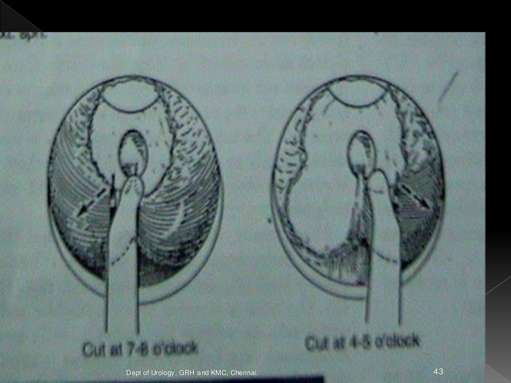 Pediatric urology : PUV- overview
