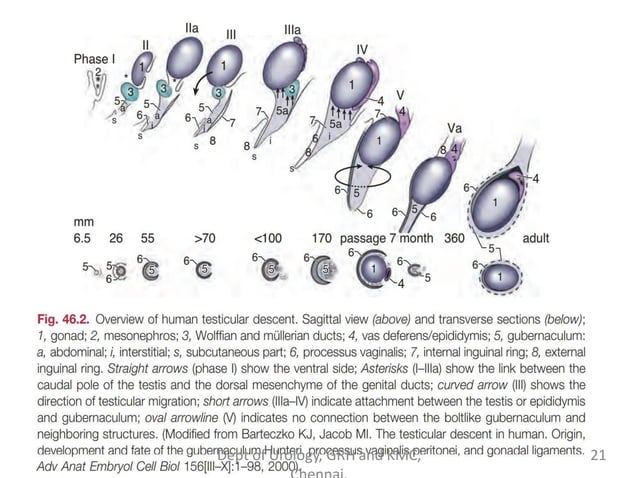 Pediatric urology :Undescended Testis (UDT) | PPT