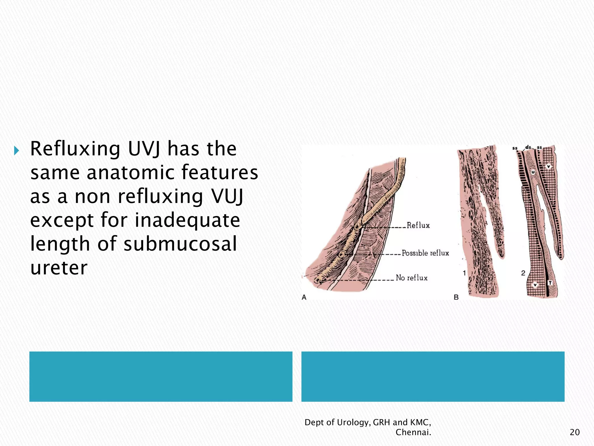 Pediatric urology : Vesicoureteric reflux(vur)- overview | PDF