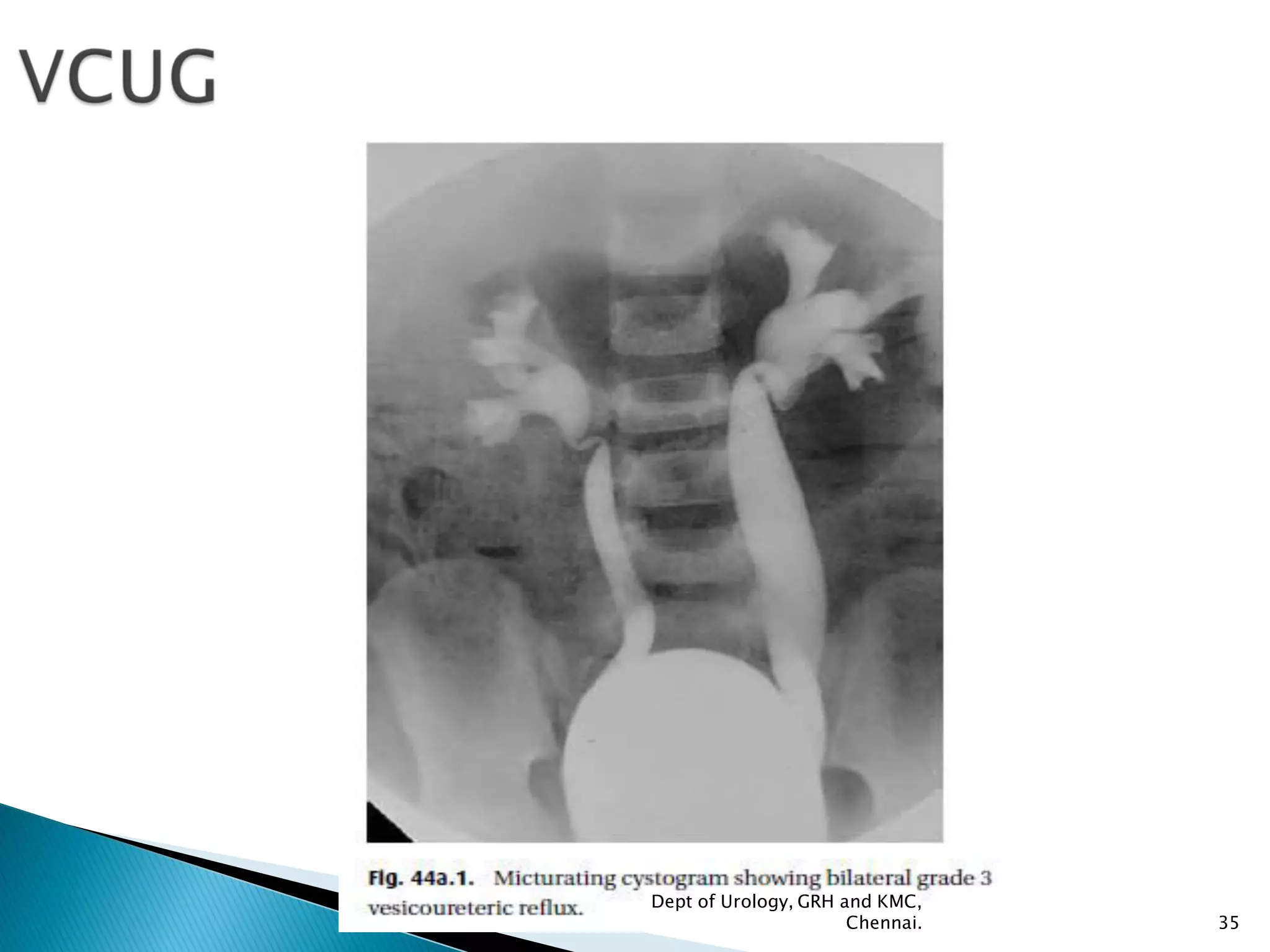 Pediatric urology : Vesicoureteric reflux(vur)- overview | PDF ...