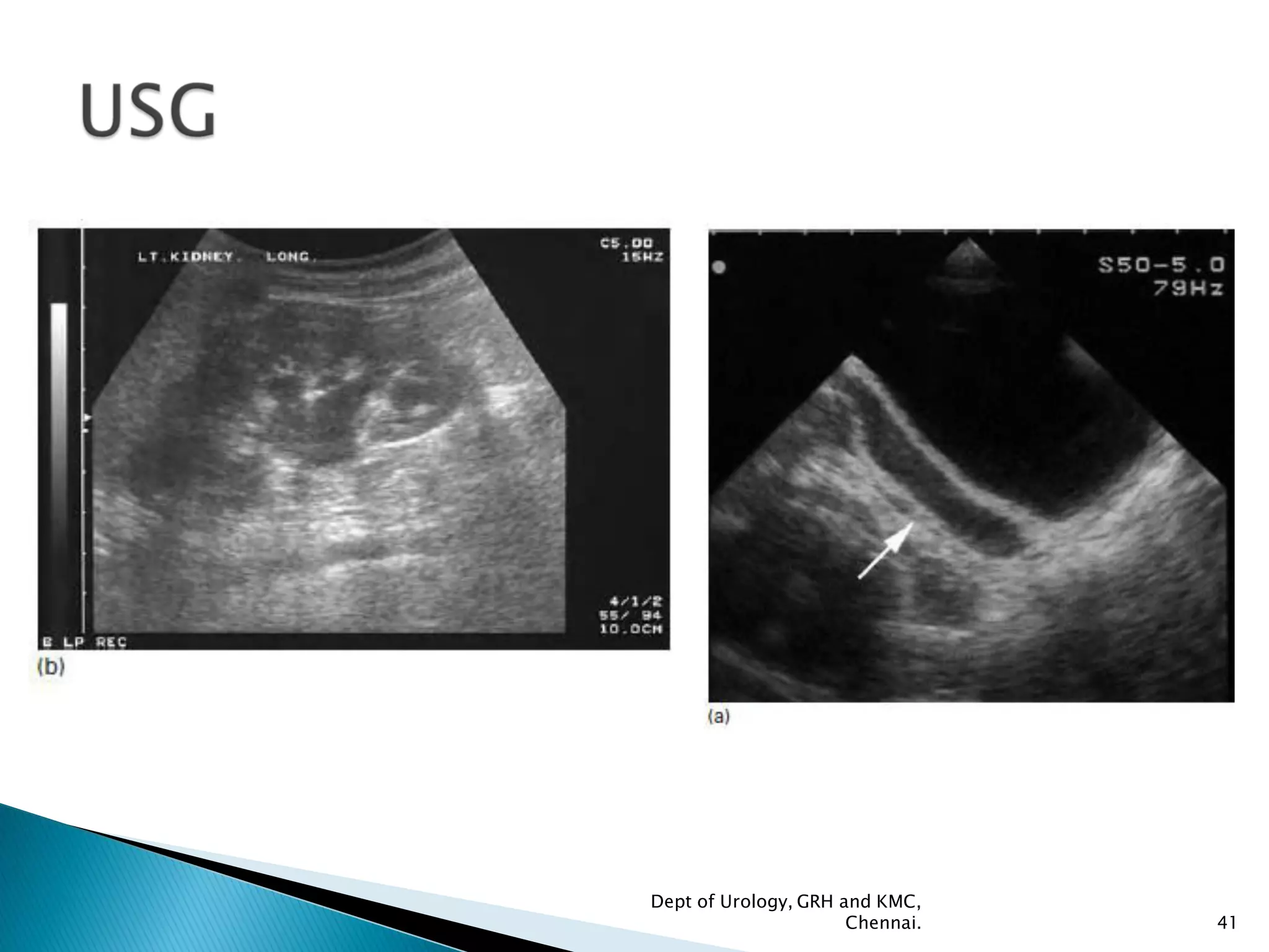 Pediatric urology : Vesicoureteric reflux(vur)- overview | PDF ...