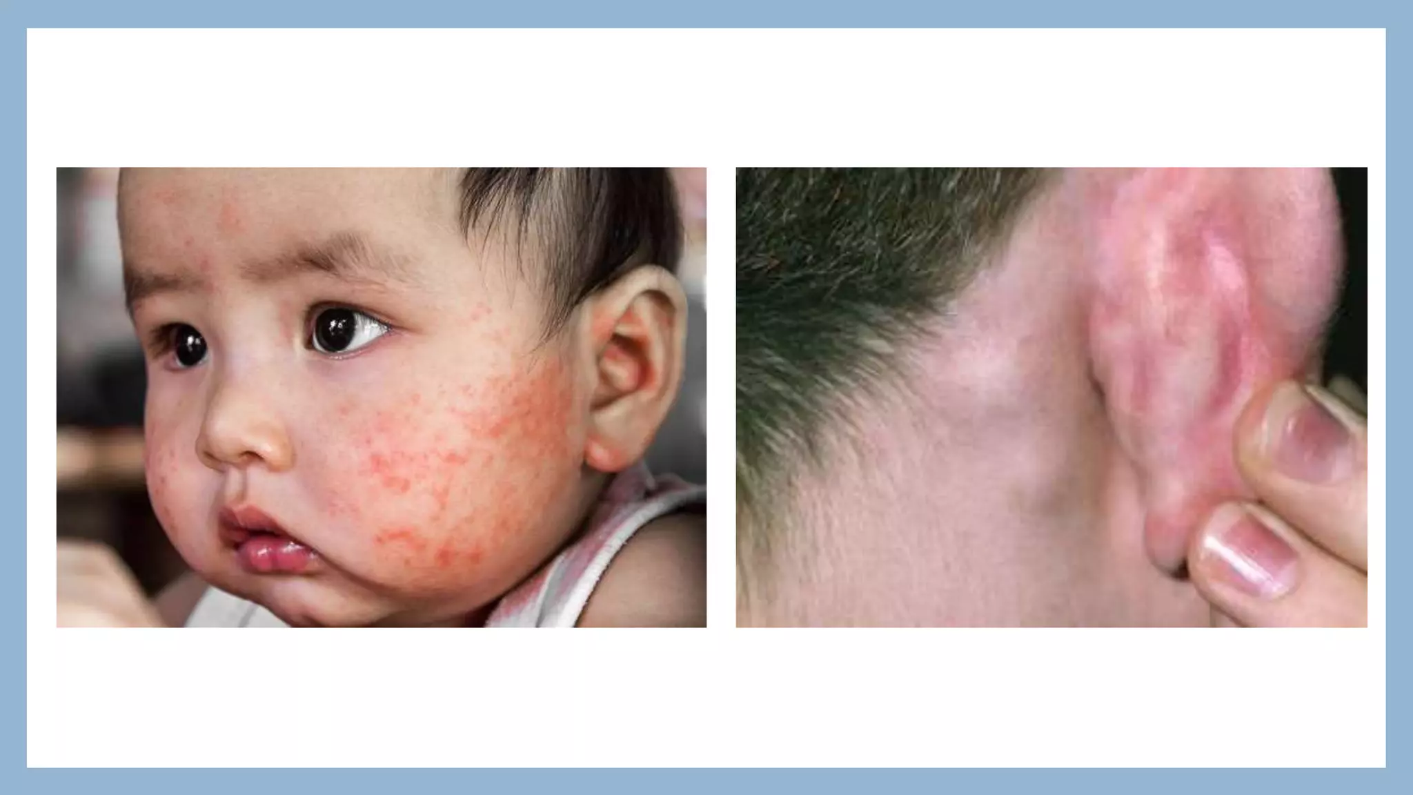 Common Pediatric Viral Exanthems | PPTX