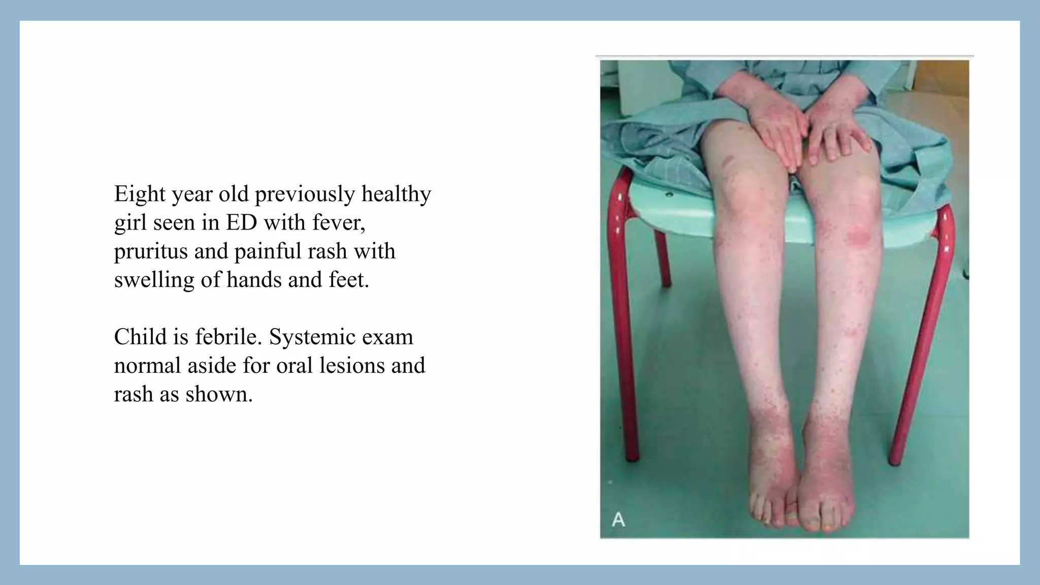 Common Pediatric Viral Exanthems | PPTX