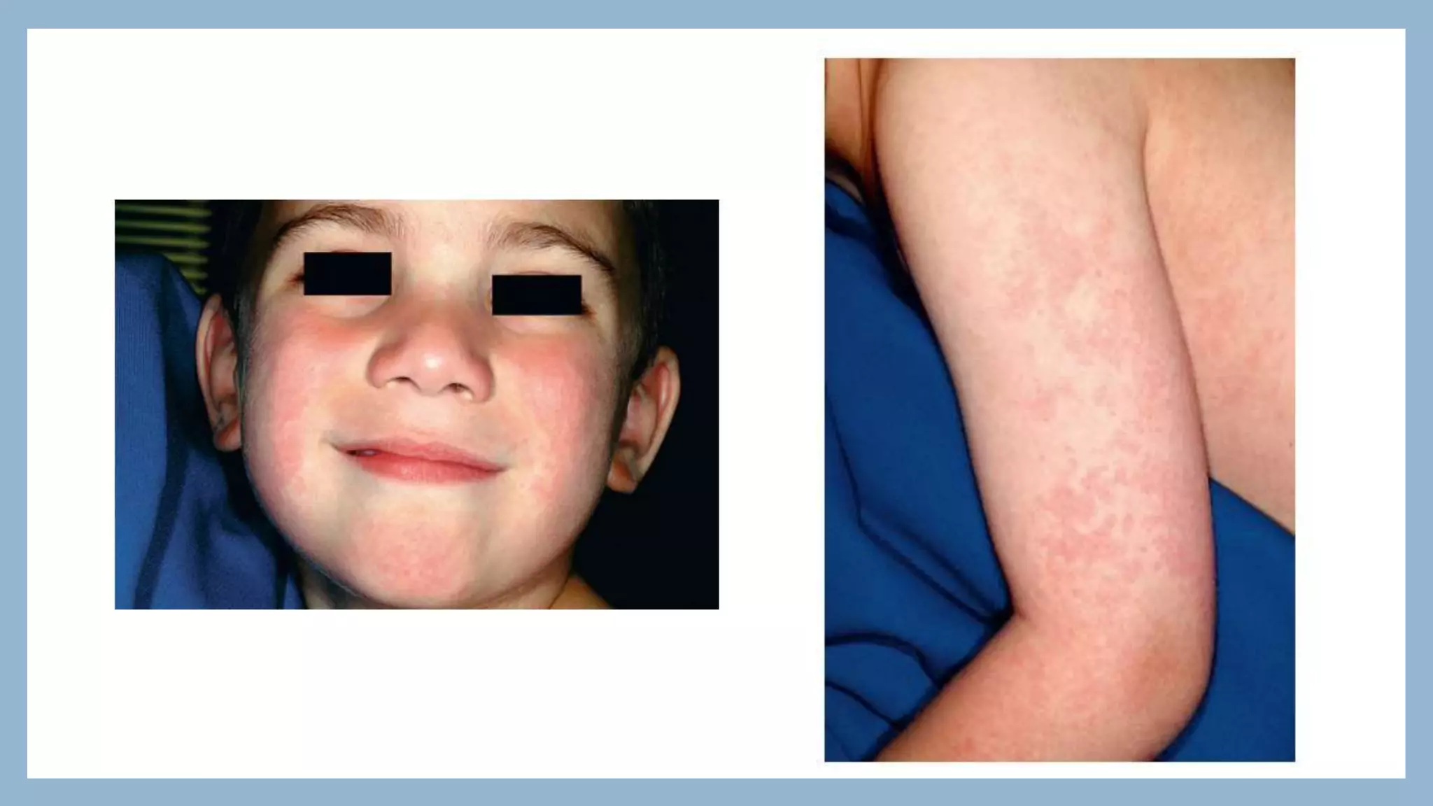 Common Pediatric Viral Exanthems | PPTX