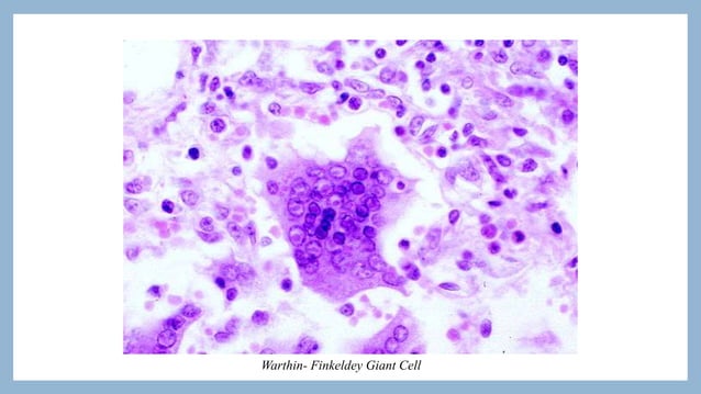 Common Pediatric Viral Exanthems | PPTX