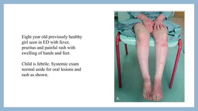 Common Pediatric Viral Exanthems | PPTX