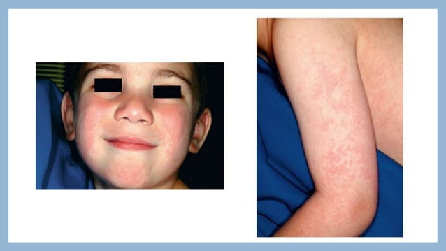 Common Pediatric Viral Exanthems | PPTX