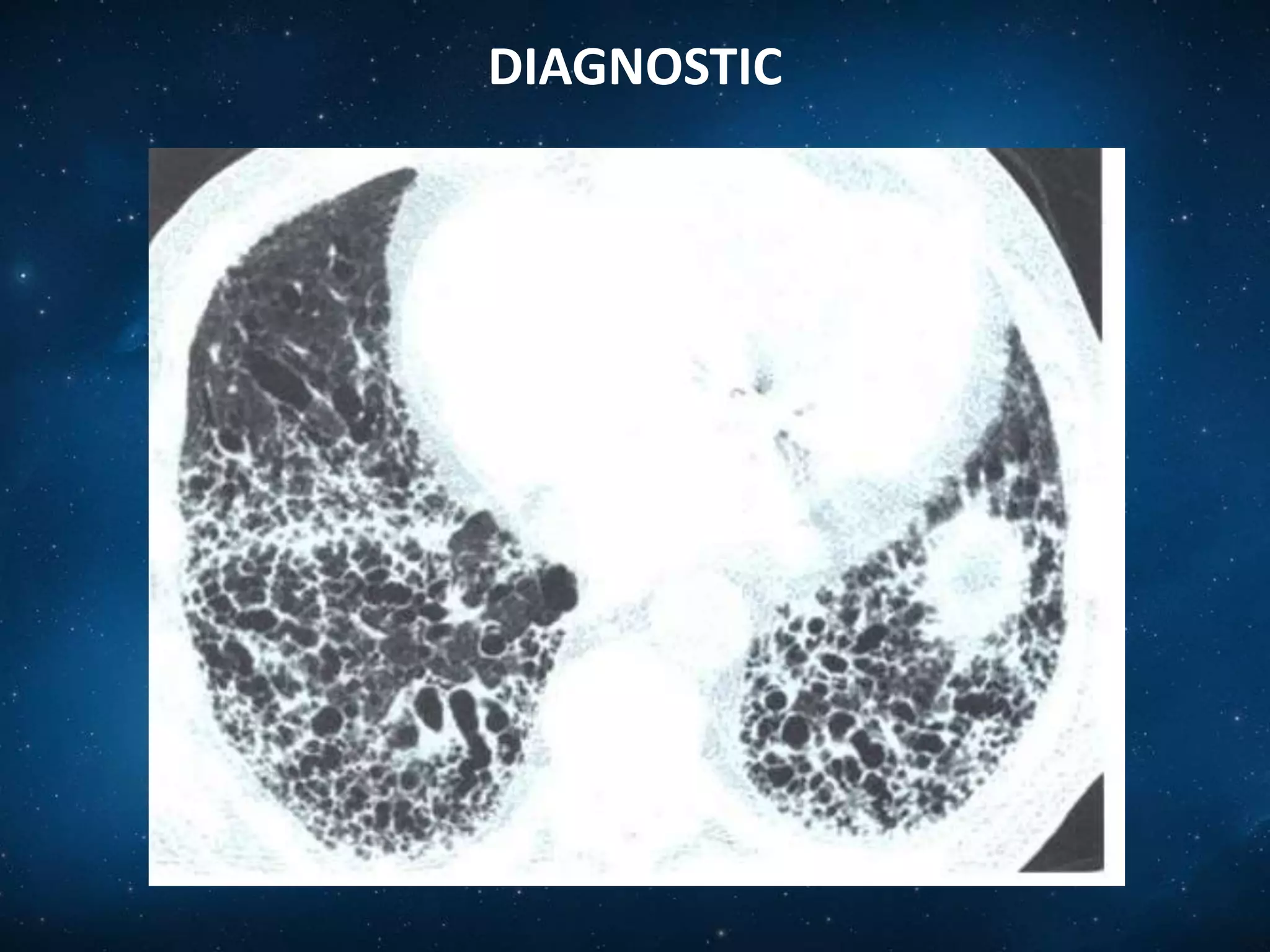 Fibroza pulmonară interstițială | PPTX