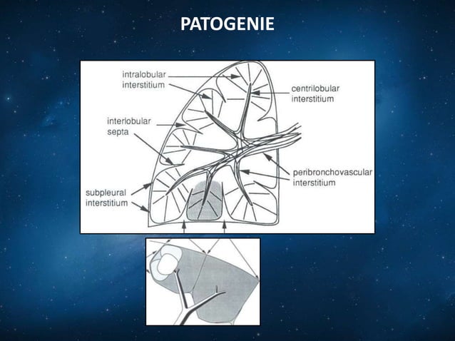 Fibroza pulmonară interstițială | PPT