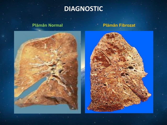 Fibroza pulmonară interstițială | PPTX