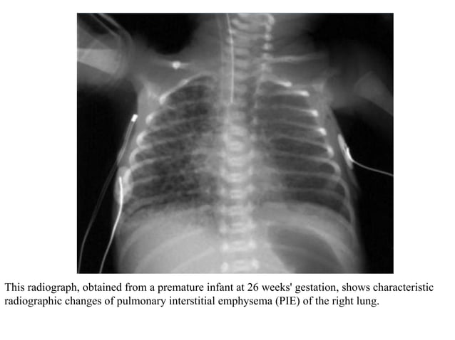 pediattric chest PPT.pptx igihihioooojooijo | PPT