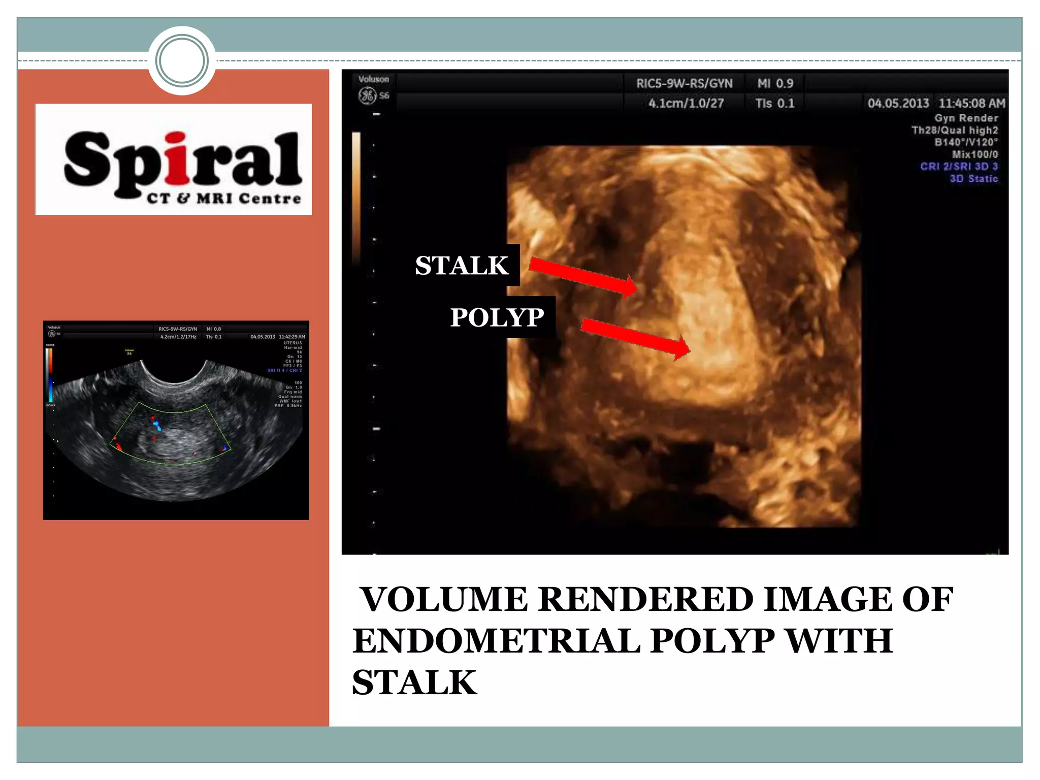 Pedicle artery sign | PPT