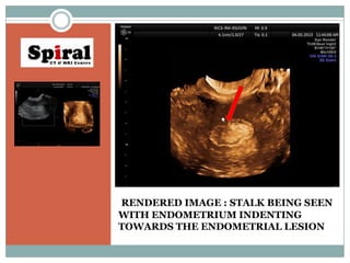 Pedicle artery sign | PPT
