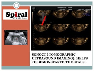 Pedicle artery sign | PPT