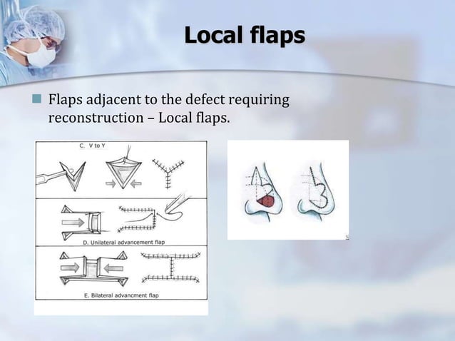 scope of Pedicled flaps in oral and maxillofacial surgery | PPTX