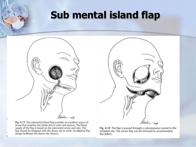 scope of Pedicled flaps in oral and maxillofacial surgery